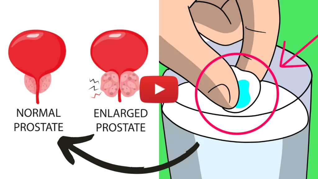 enlarged-prostate - vitalprostate.blog